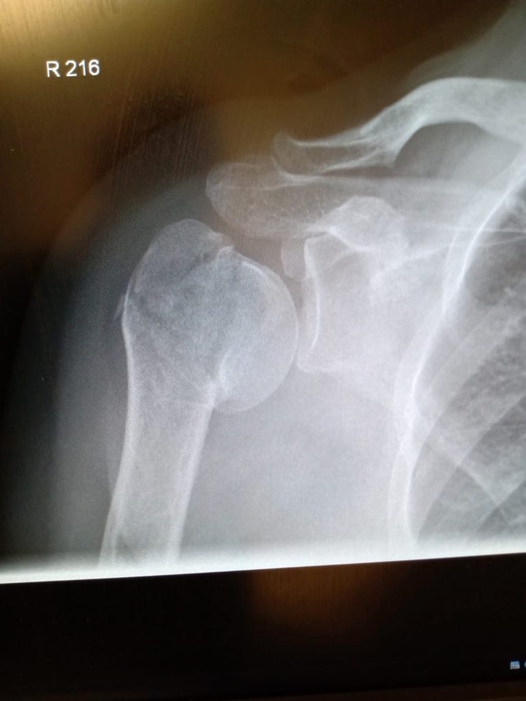 Fractured Shoulder - ball and socket replacement required - Cosmodic